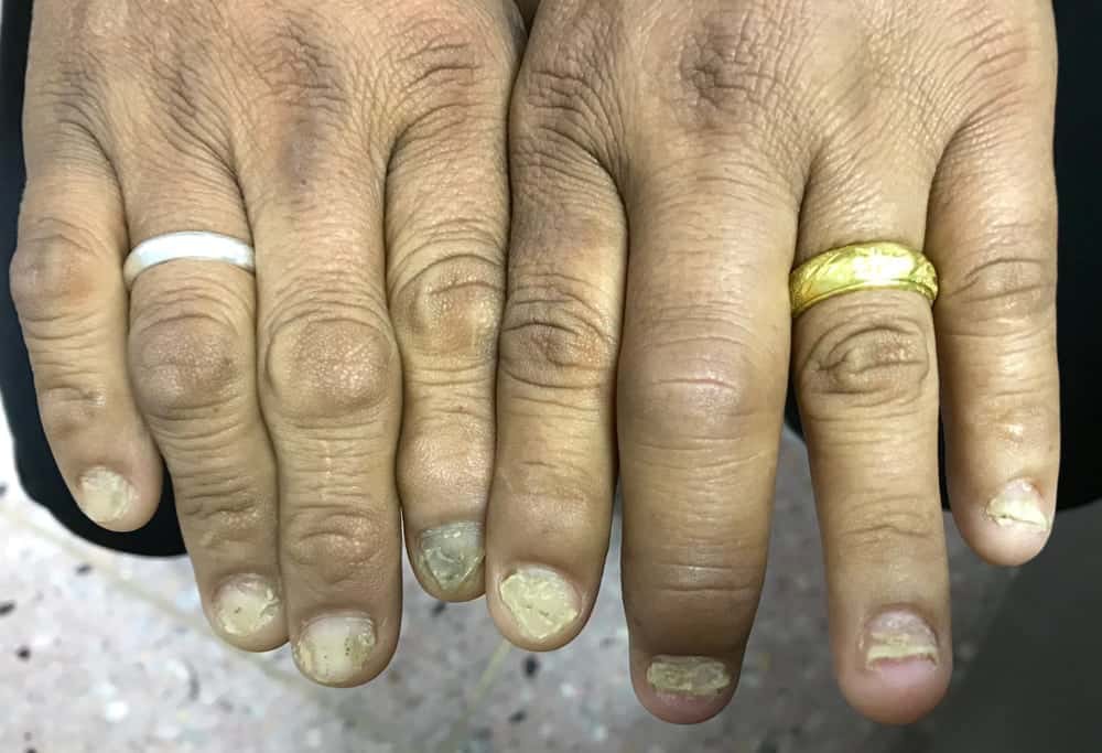 What Your Fingernails Say About Your Health - GreenSmoothieGirl