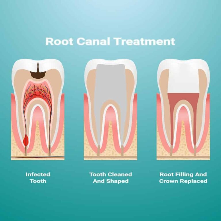 Why Root Canals Fail, and What to Do About It - GreenSmoothieGirl