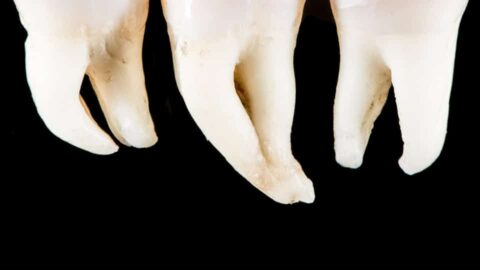 Why Root Canals Fail, and What to Do About It - GreenSmoothieGirl