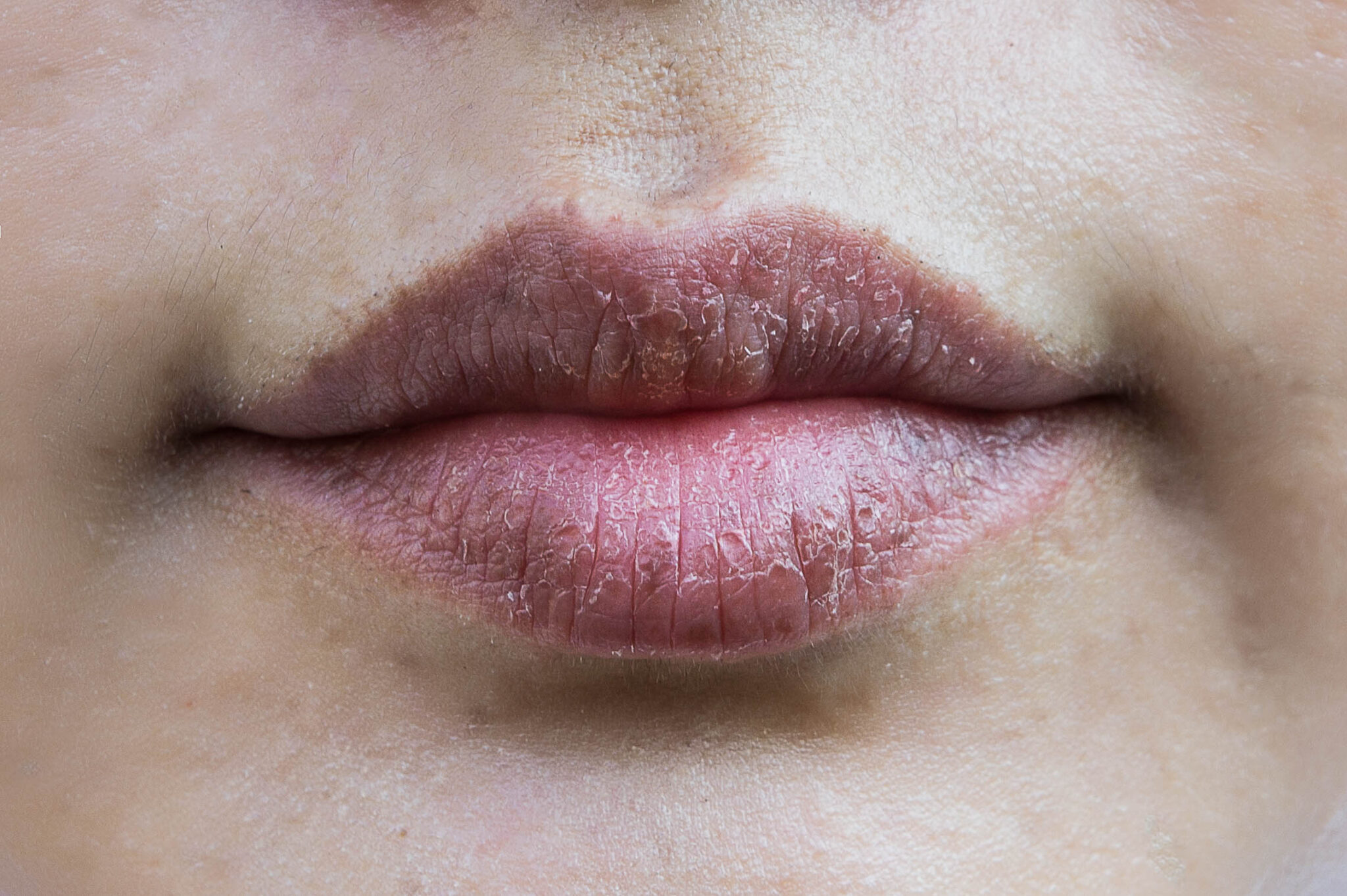 What Causes Dry Mouth? Know The Symptoms & Solutions